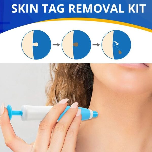 Skin Tag & Wart Removal - Eliminate Acrochordon On Skin Eyelid Neck ...